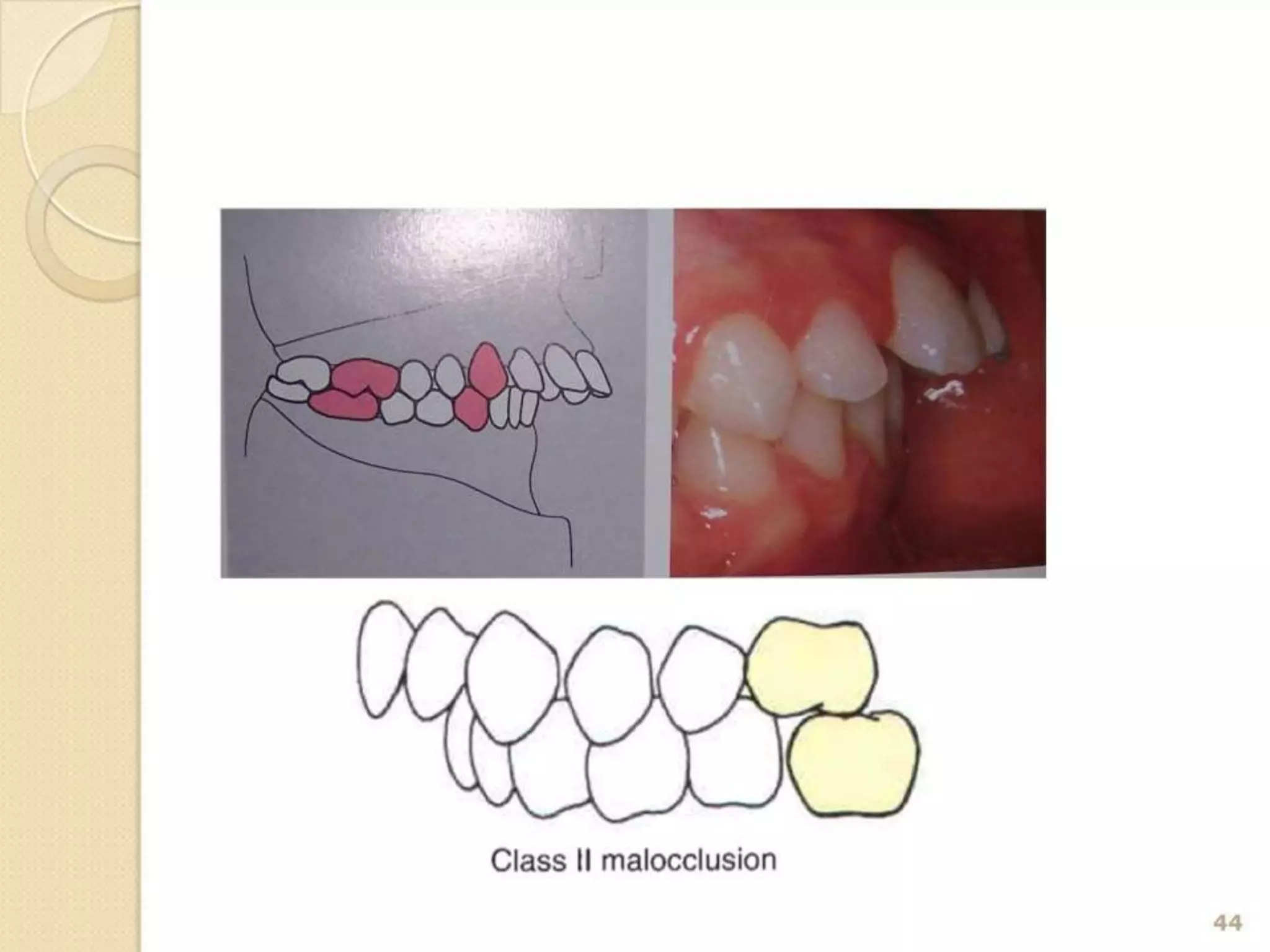 Classification of malocclusion | PPT