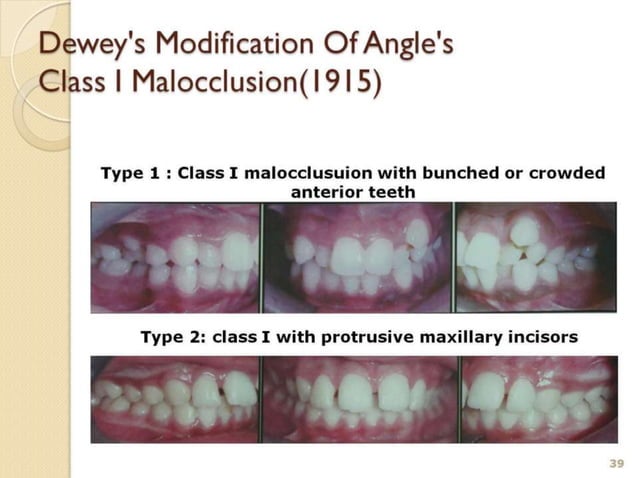 Classification of malocclusion | PPT