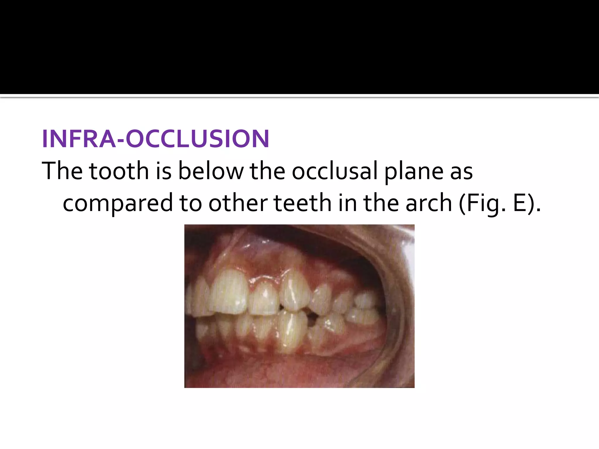Classification of malocclusion | PPT