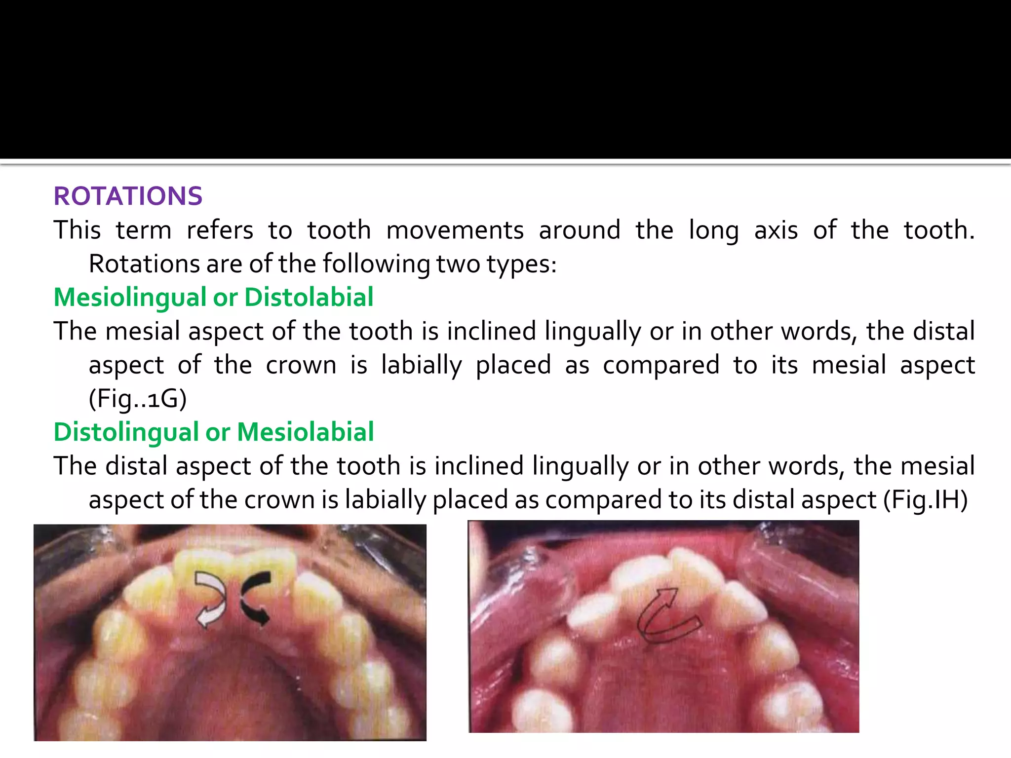 Classification of malocclusion | PPT