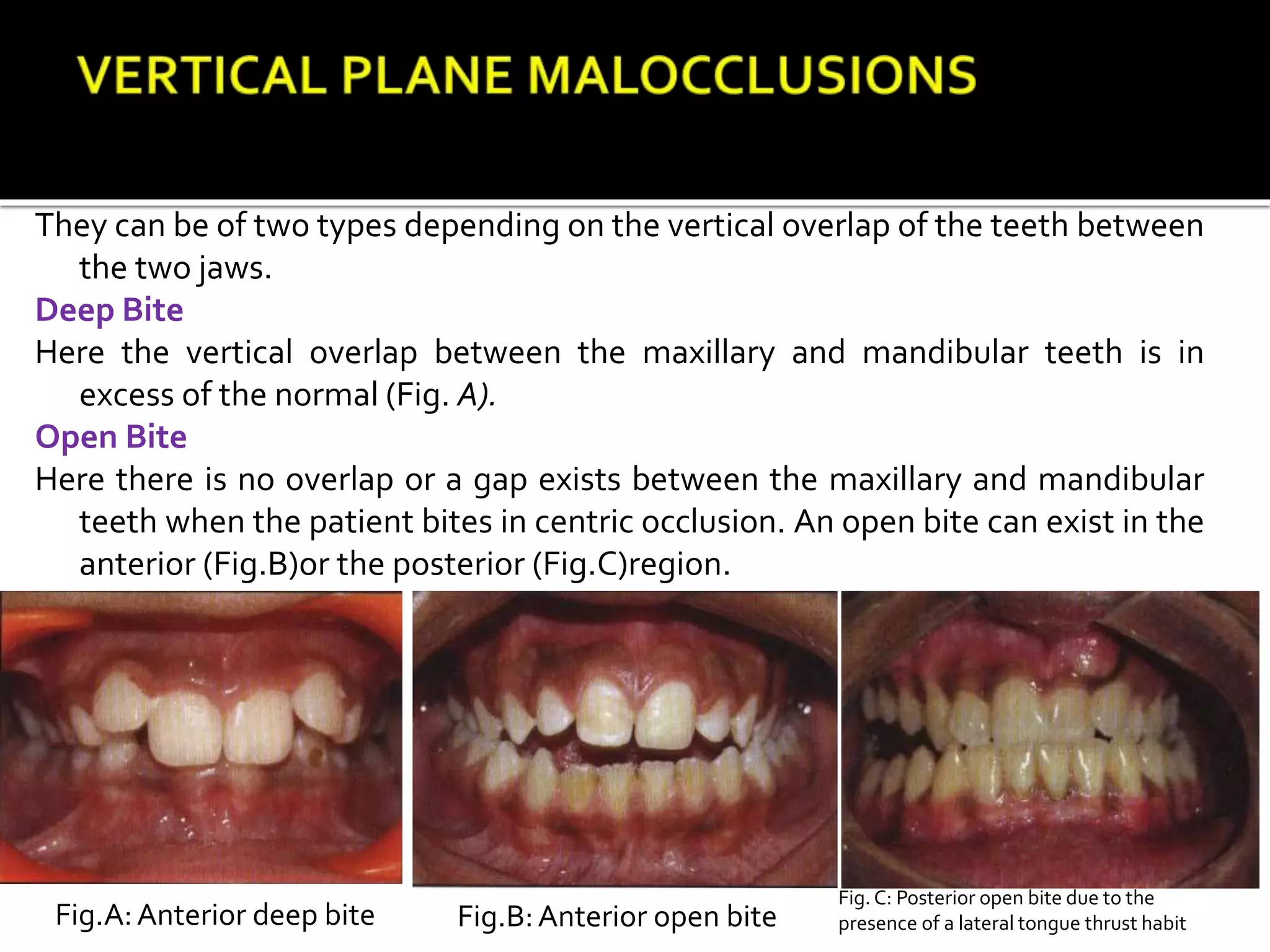 Classification of malocclusion | PPT | Dental Health | Diseases and ...