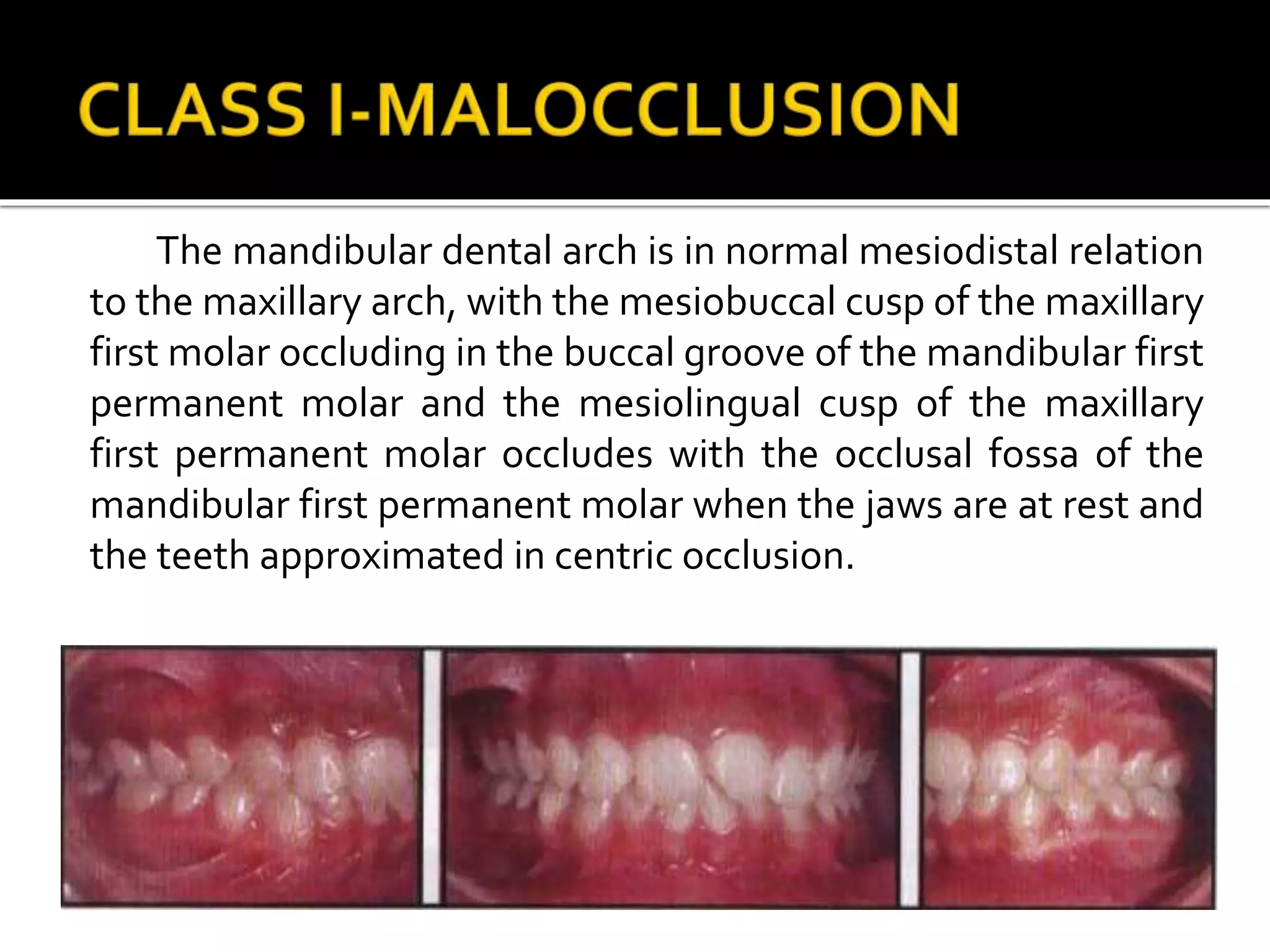 Classification of malocclusion | PPT | Dental Health | Diseases and ...
