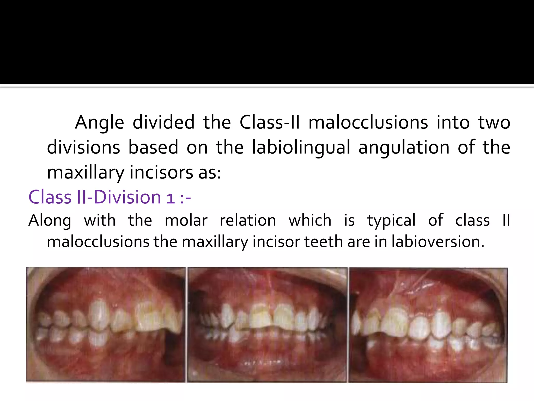 Classification of malocclusion | PPT | Dental Health | Diseases and ...