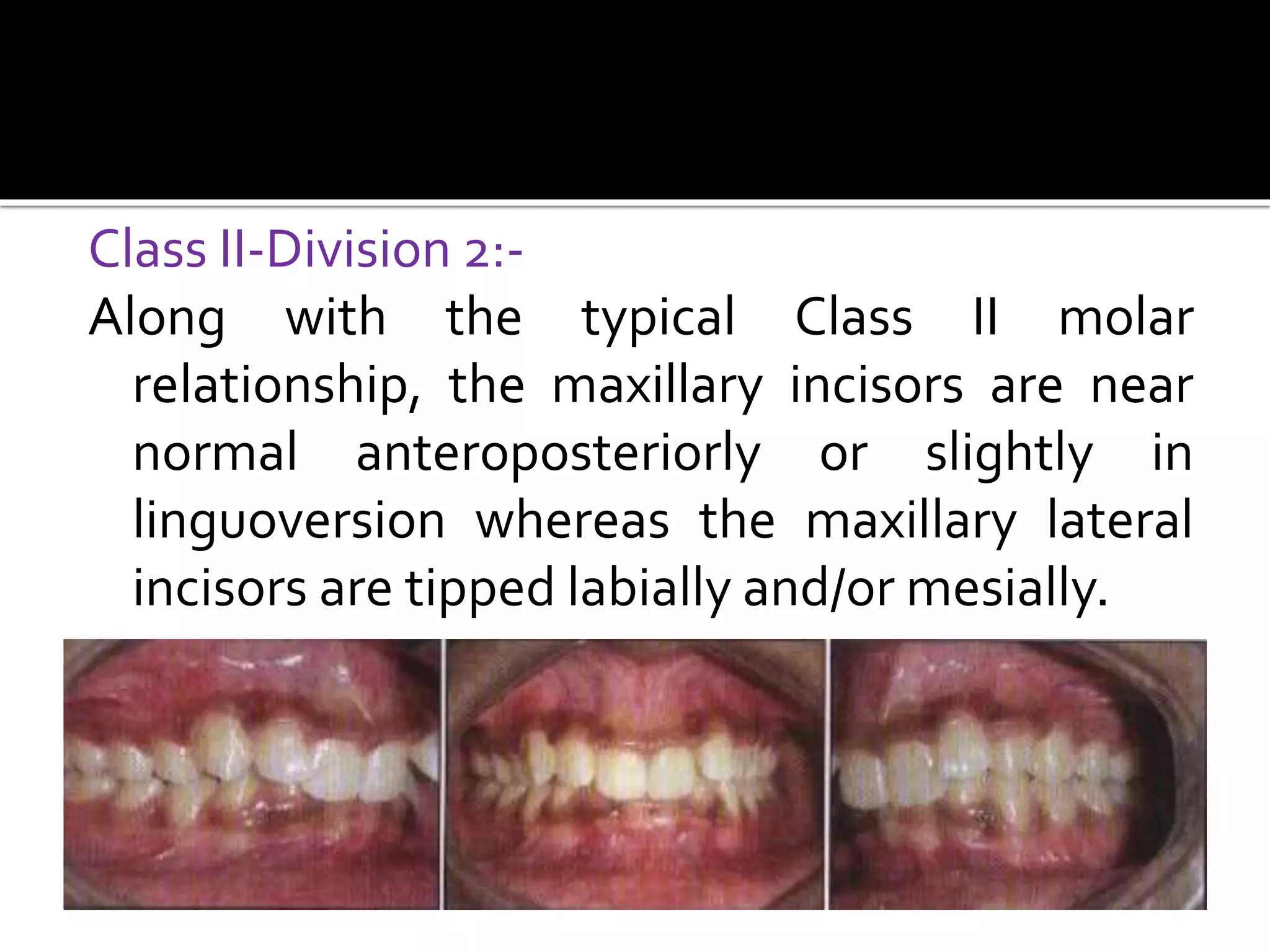 Classification of malocclusion | PPT