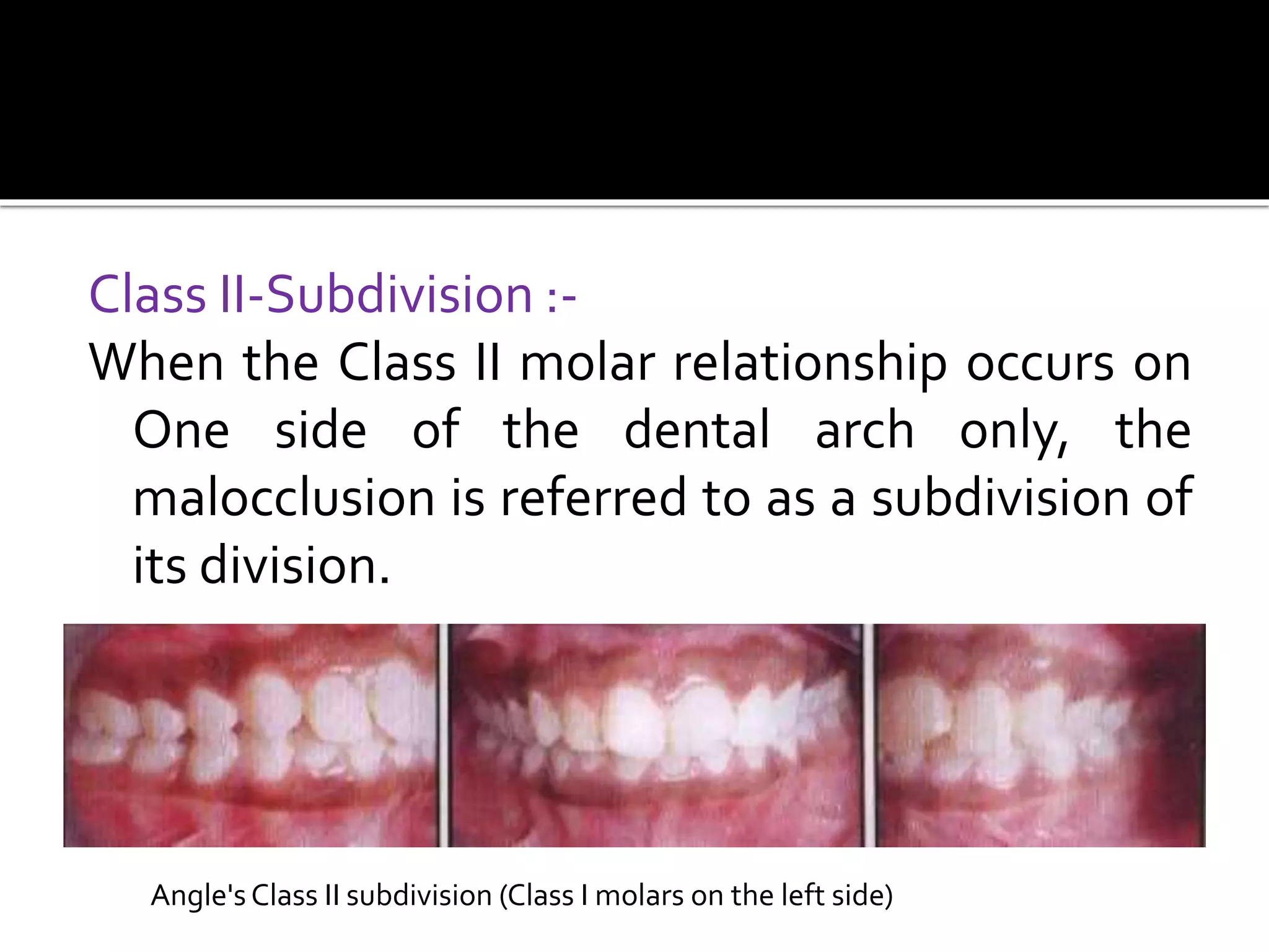 Classification of malocclusion | PPT | Dental Health | Diseases and ...