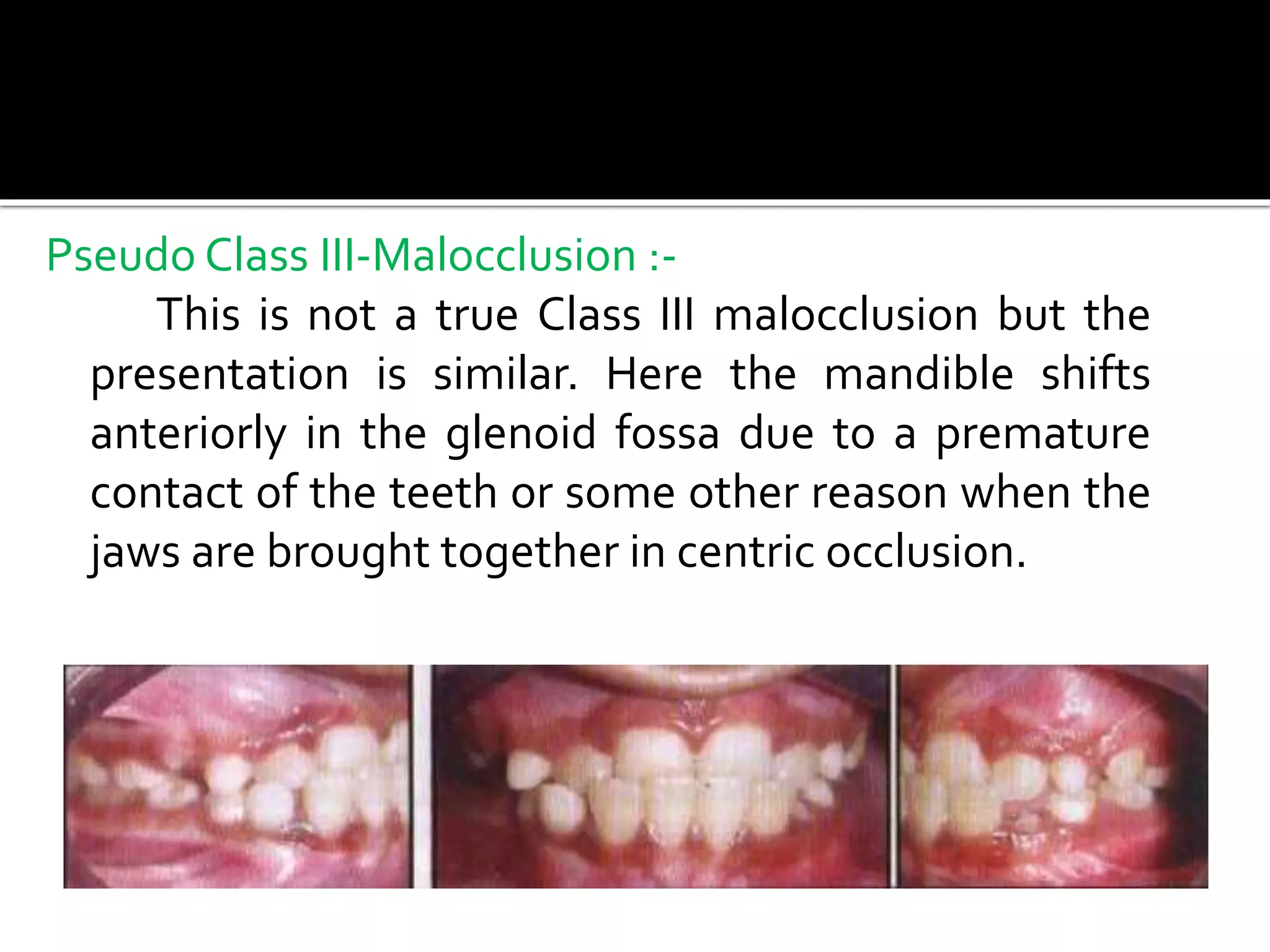 Classification of malocclusion | PPT