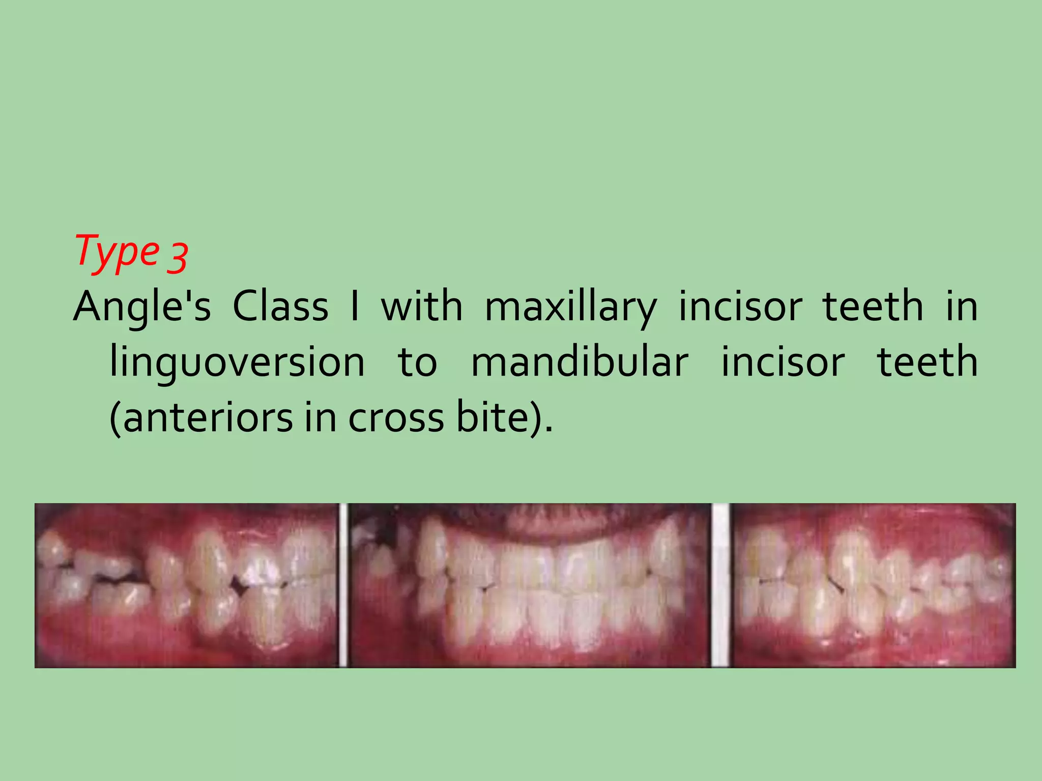Classification of malocclusion | PPT | Dental Health | Diseases and ...