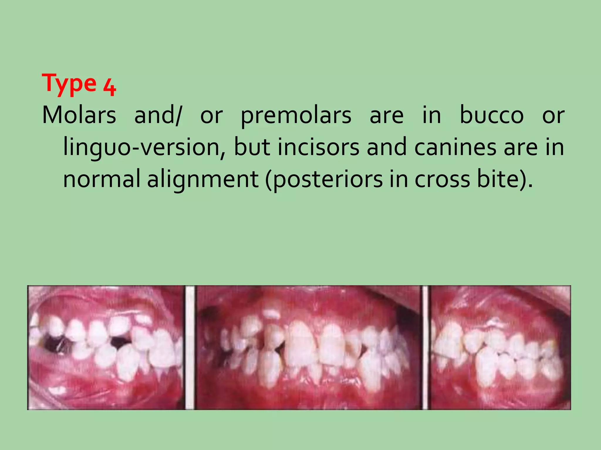 Classification of malocclusion | PPT | Dental Health | Diseases and ...