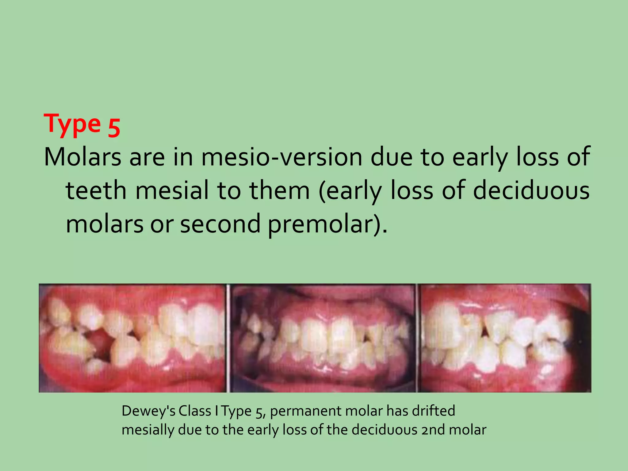 Classification of malocclusion | PPT | Dental Health | Diseases and ...