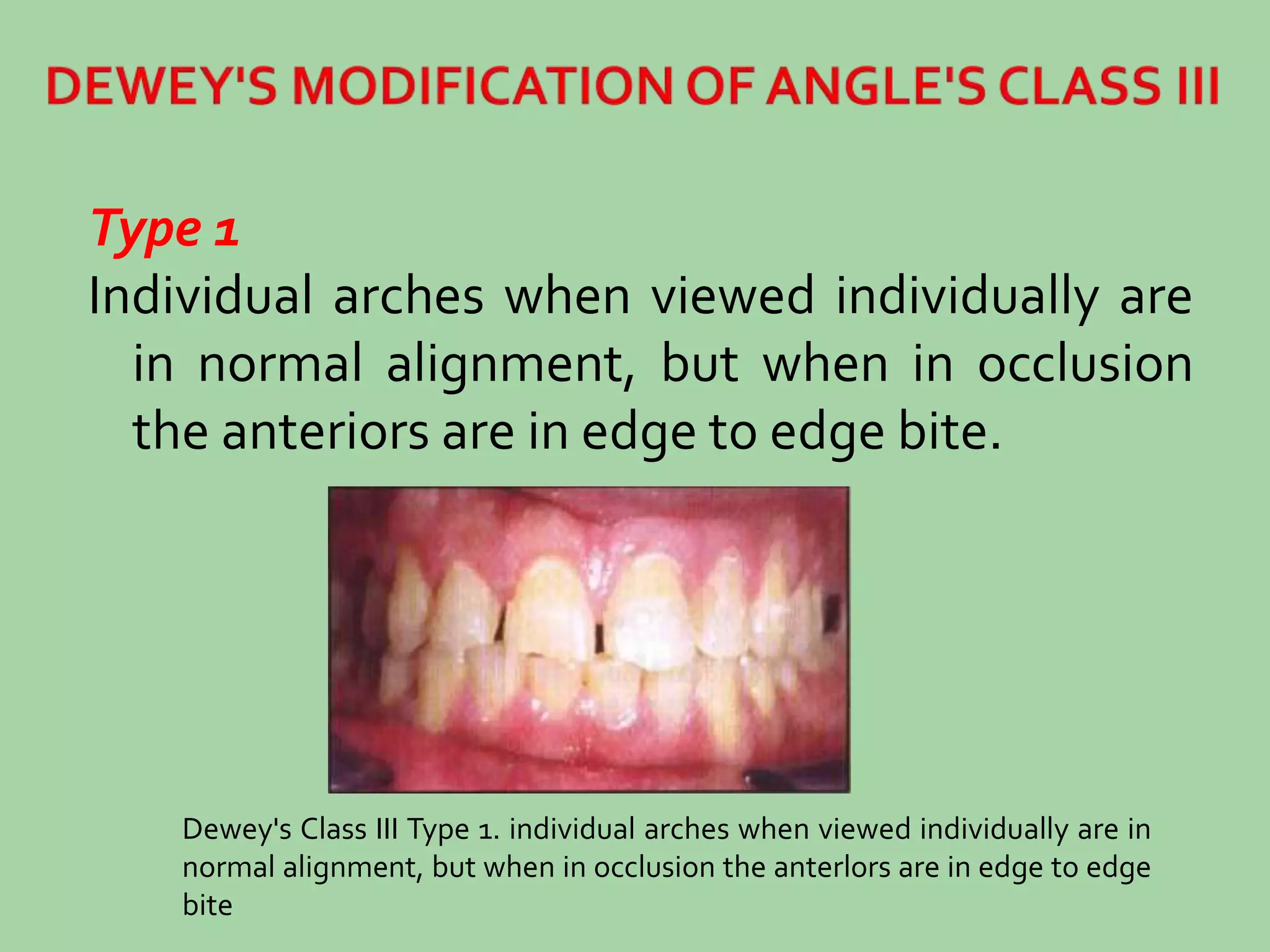 Classification of malocclusion | PPT | Dental Health | Diseases and ...