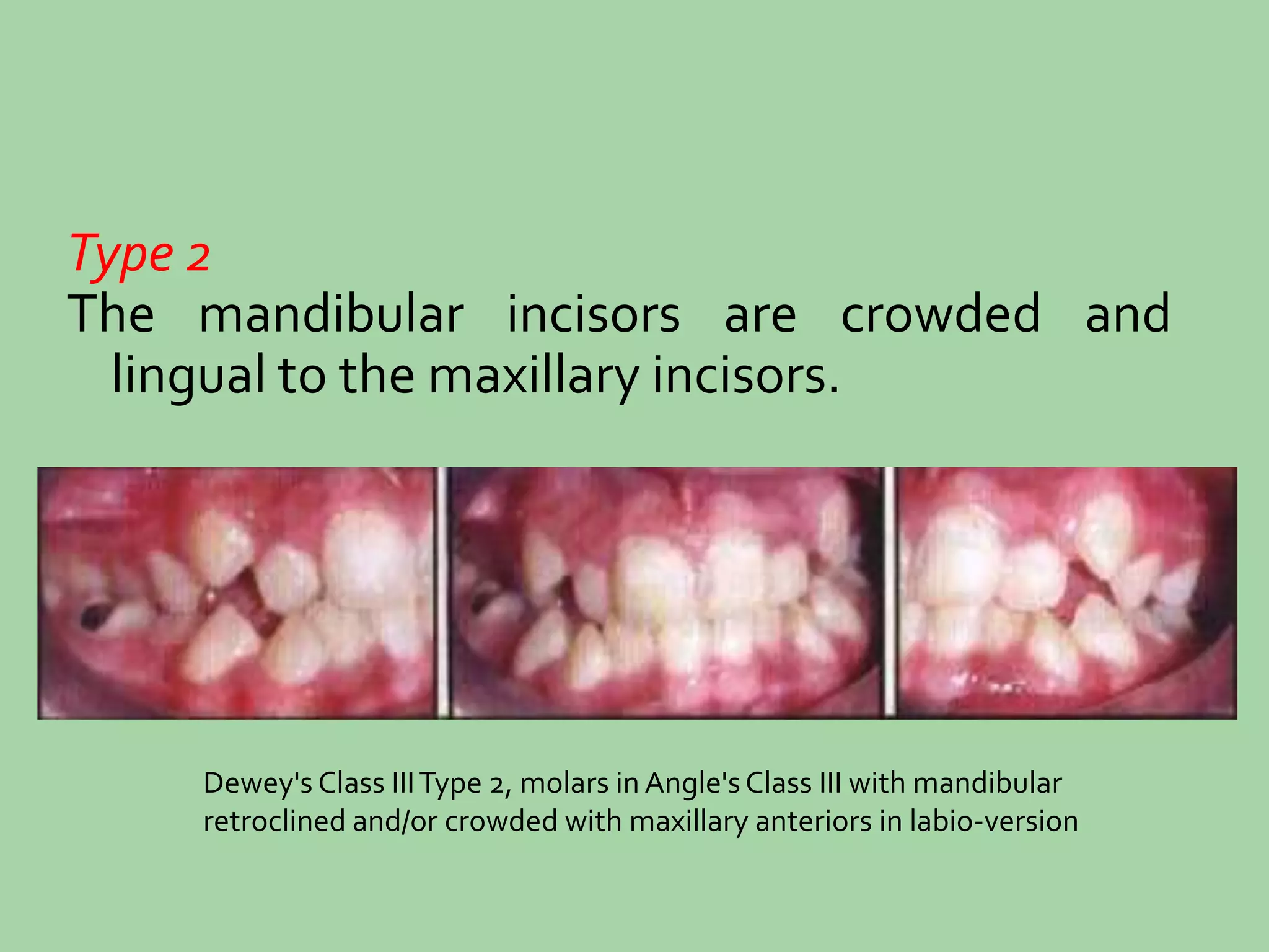 Classification of malocclusion | PPT | Dental Health | Diseases and ...