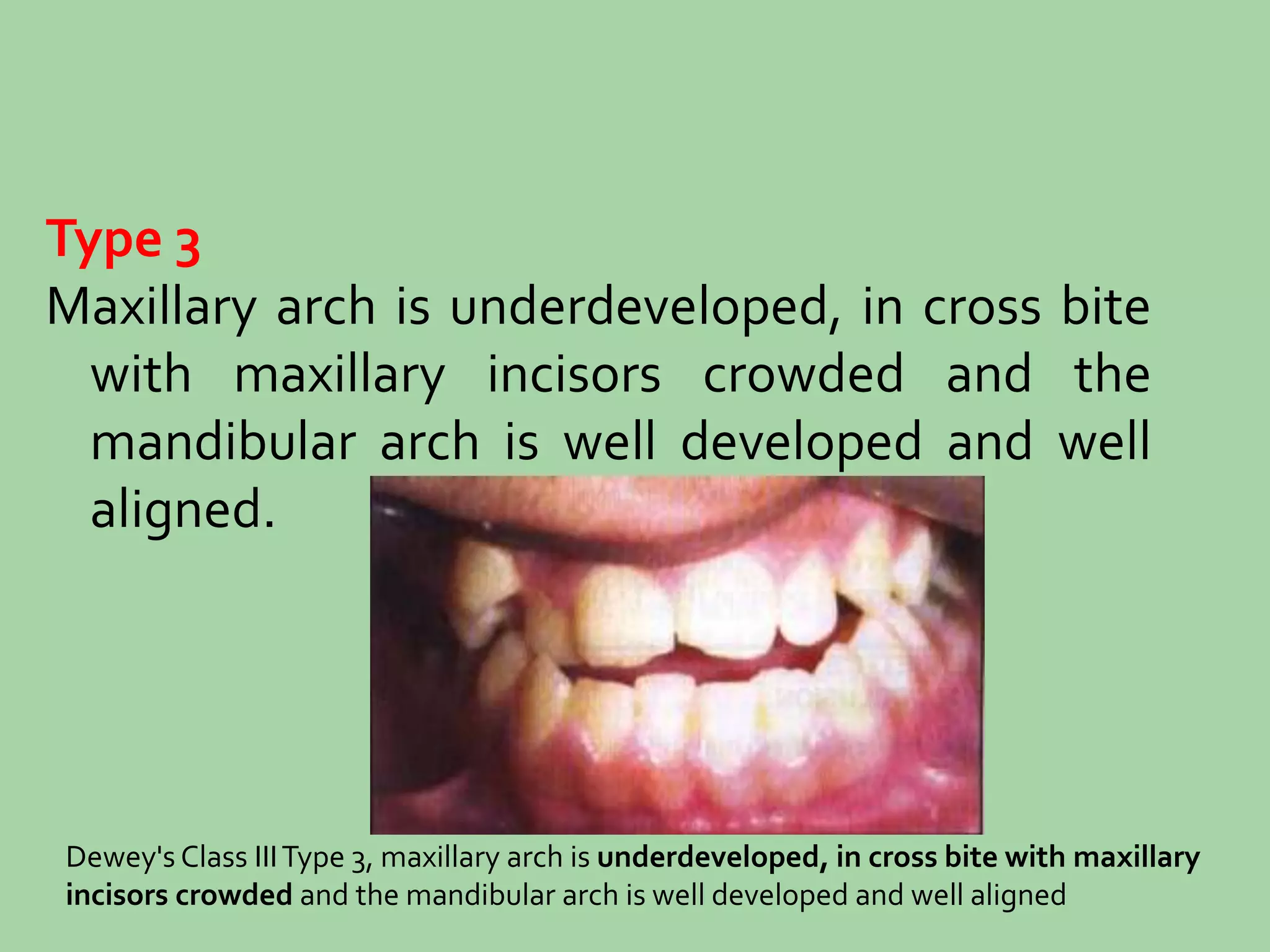 Classification of malocclusion | PPT | Dental Health | Diseases and ...