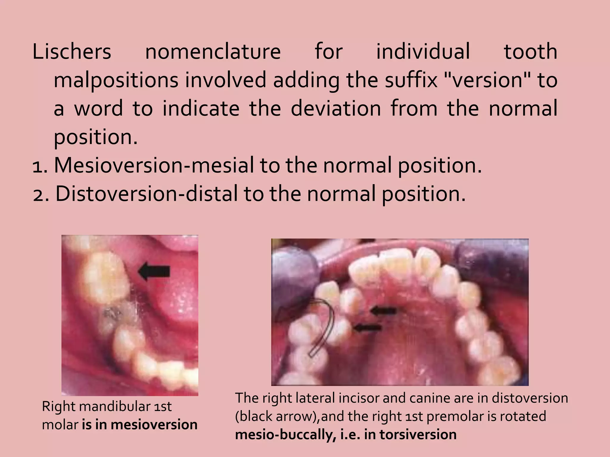 Classification of malocclusion | PPT