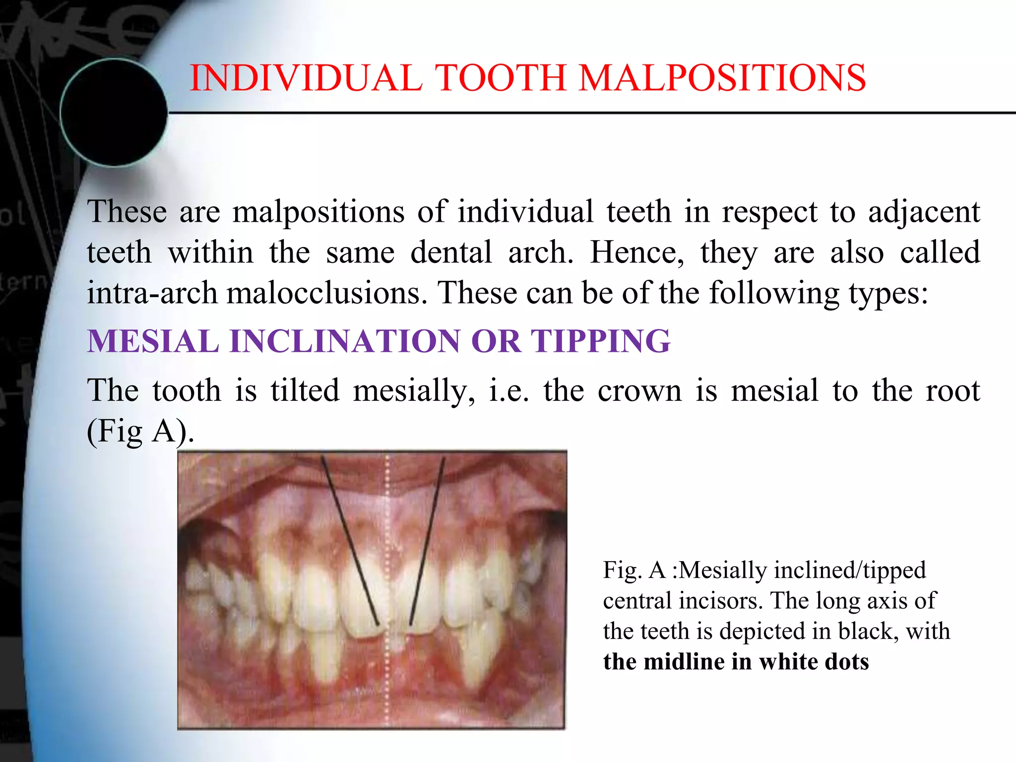 Classification of malocclusion | PPT | Dental Health | Diseases and ...
