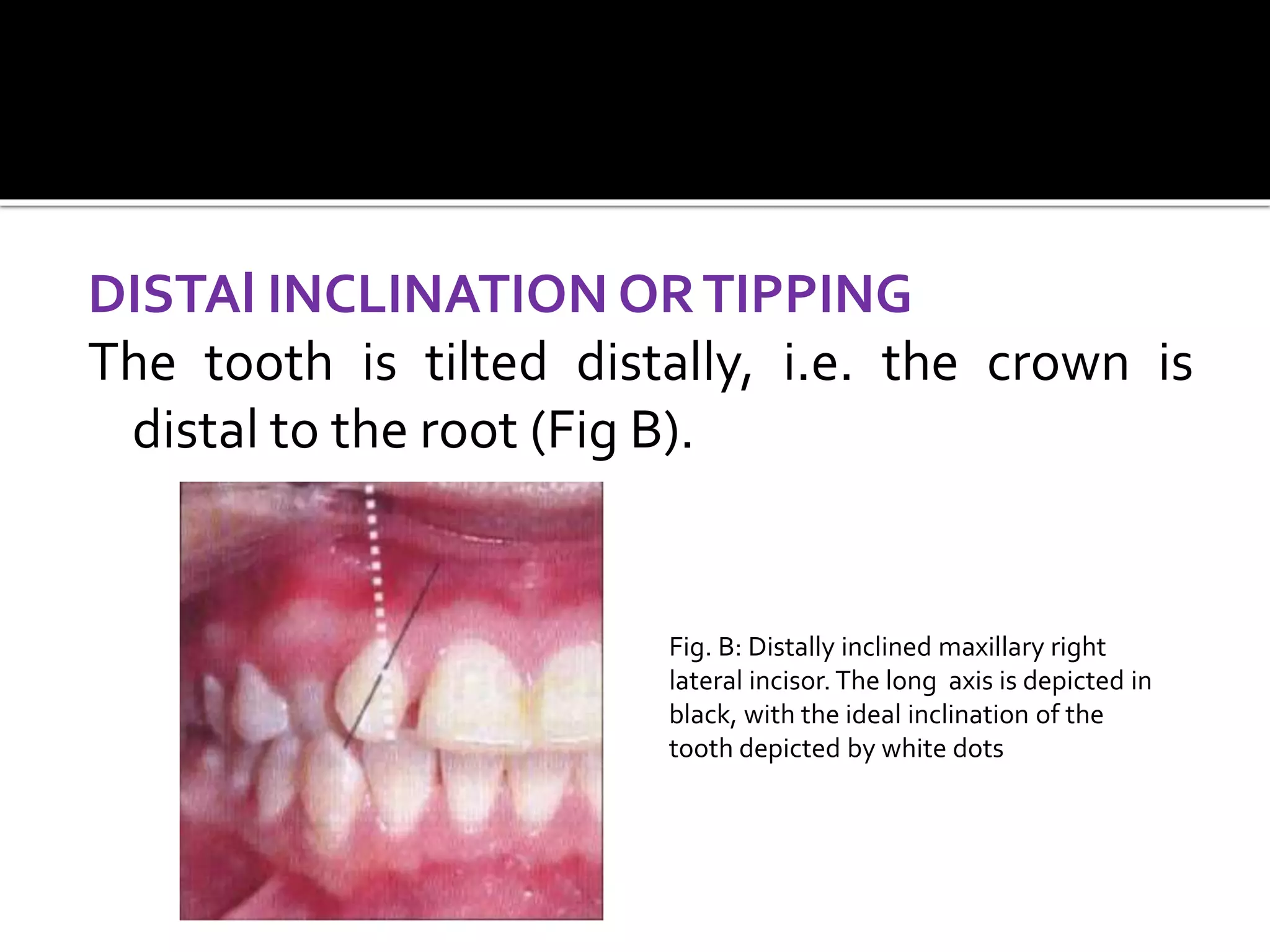Classification of malocclusion | PPT