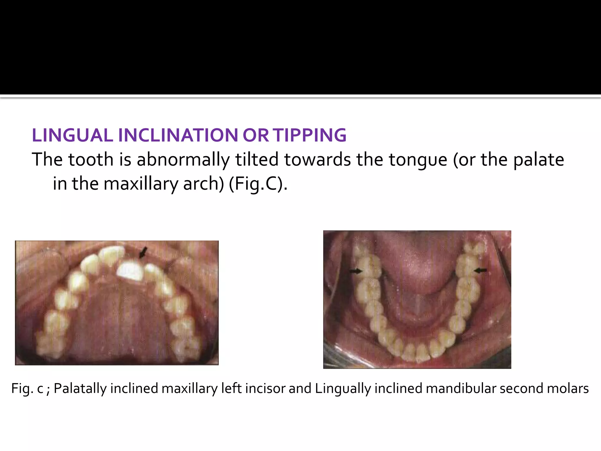 Classification of malocclusion | PPT