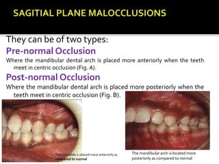 Classification of malocclusion | PPT