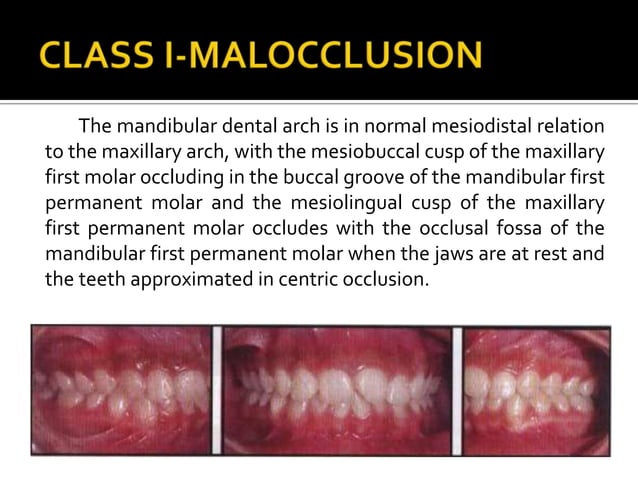 Classification of malocclusion | PPT | Dental Health | Diseases and ...