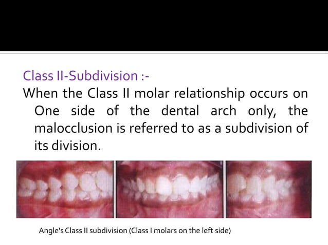 Classification of malocclusion | PPT | Dental Health | Diseases and ...