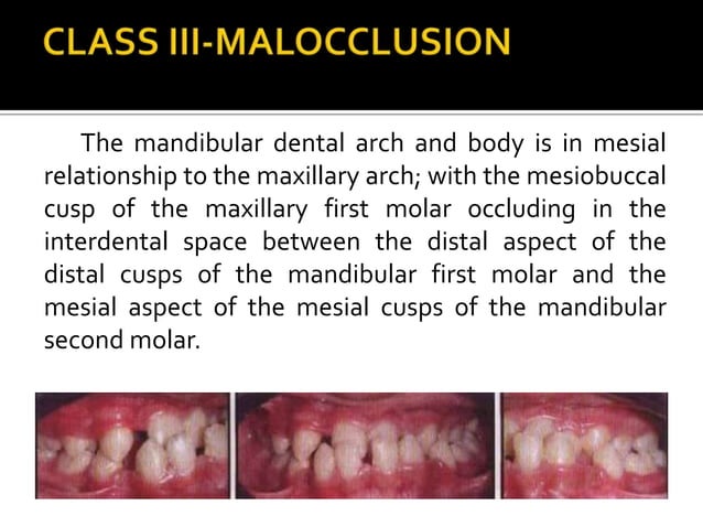Classification of malocclusion | PPT | Dental Health | Diseases and ...