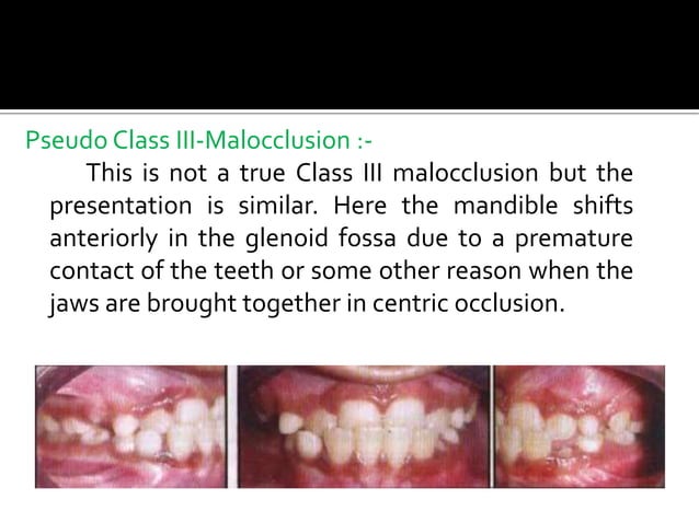 Classification of malocclusion | PPT | Dental Health | Diseases and ...