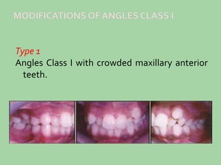 Classification of malocclusion | PPT