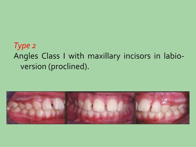 Classification of malocclusion | PPT | Dental Health | Diseases and ...