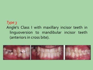 Classification of malocclusion | PPT