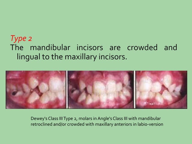 Classification of malocclusion | PPT | Dental Health | Diseases and ...