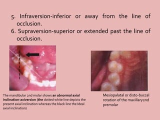 Classification of malocclusion | PPT