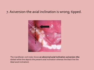 Classification of malocclusion | PPT