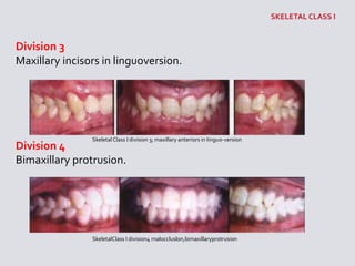 Classification of malocclusion | PPT
