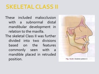 Classification of malocclusion | PPT