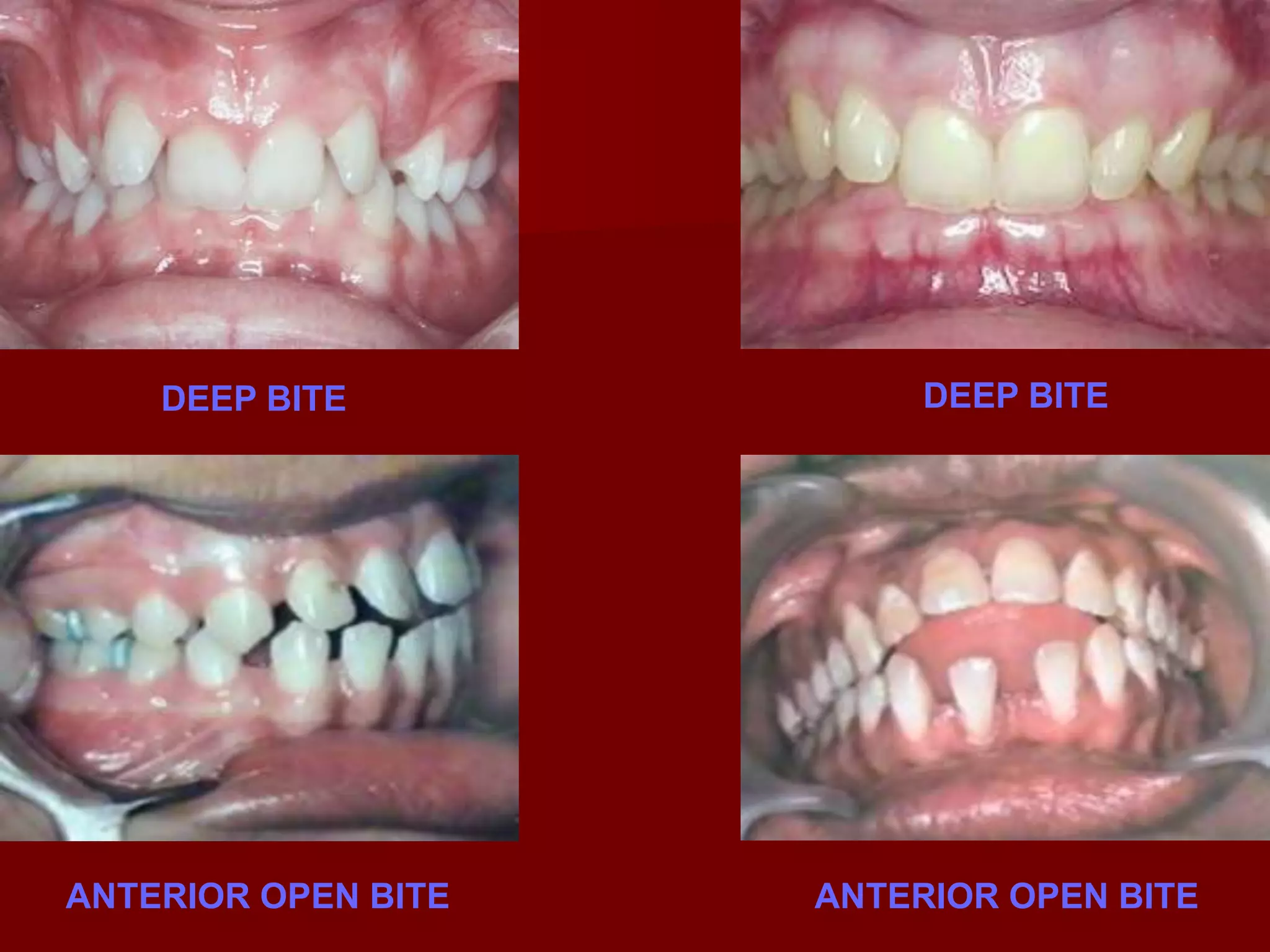 Classification of malocclusion | PPT