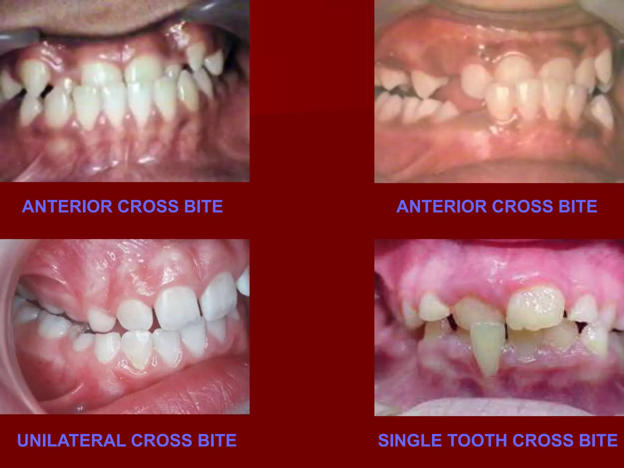 Classification of malocclusion | PPT