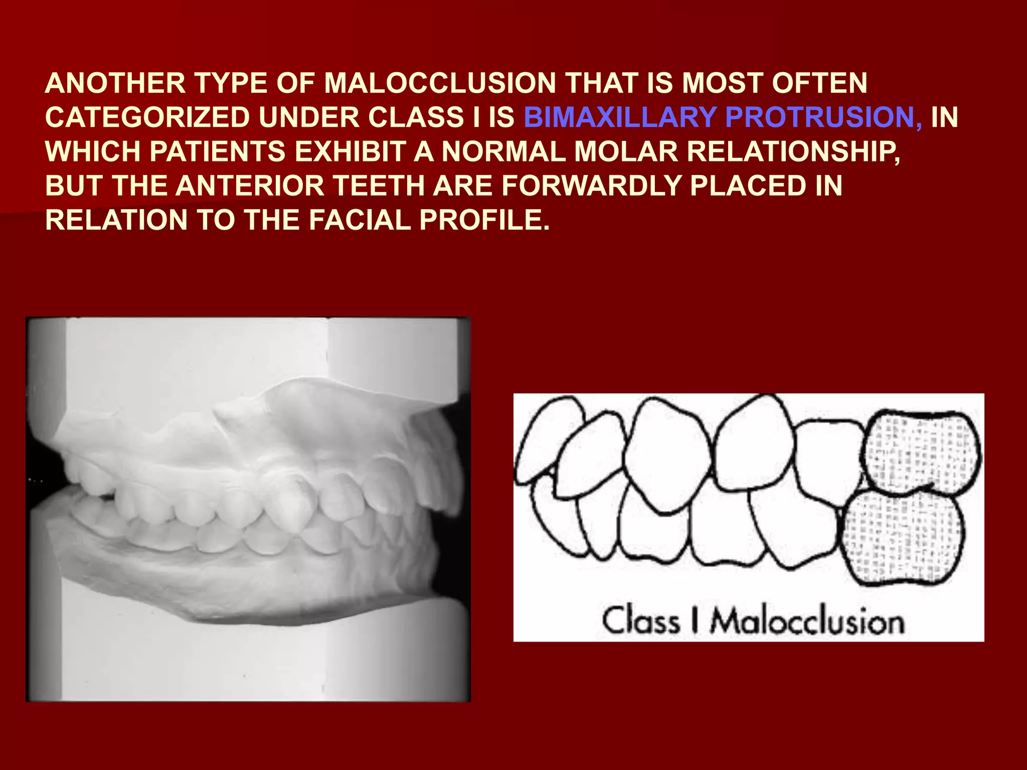 Classification of malocclusion | PPT