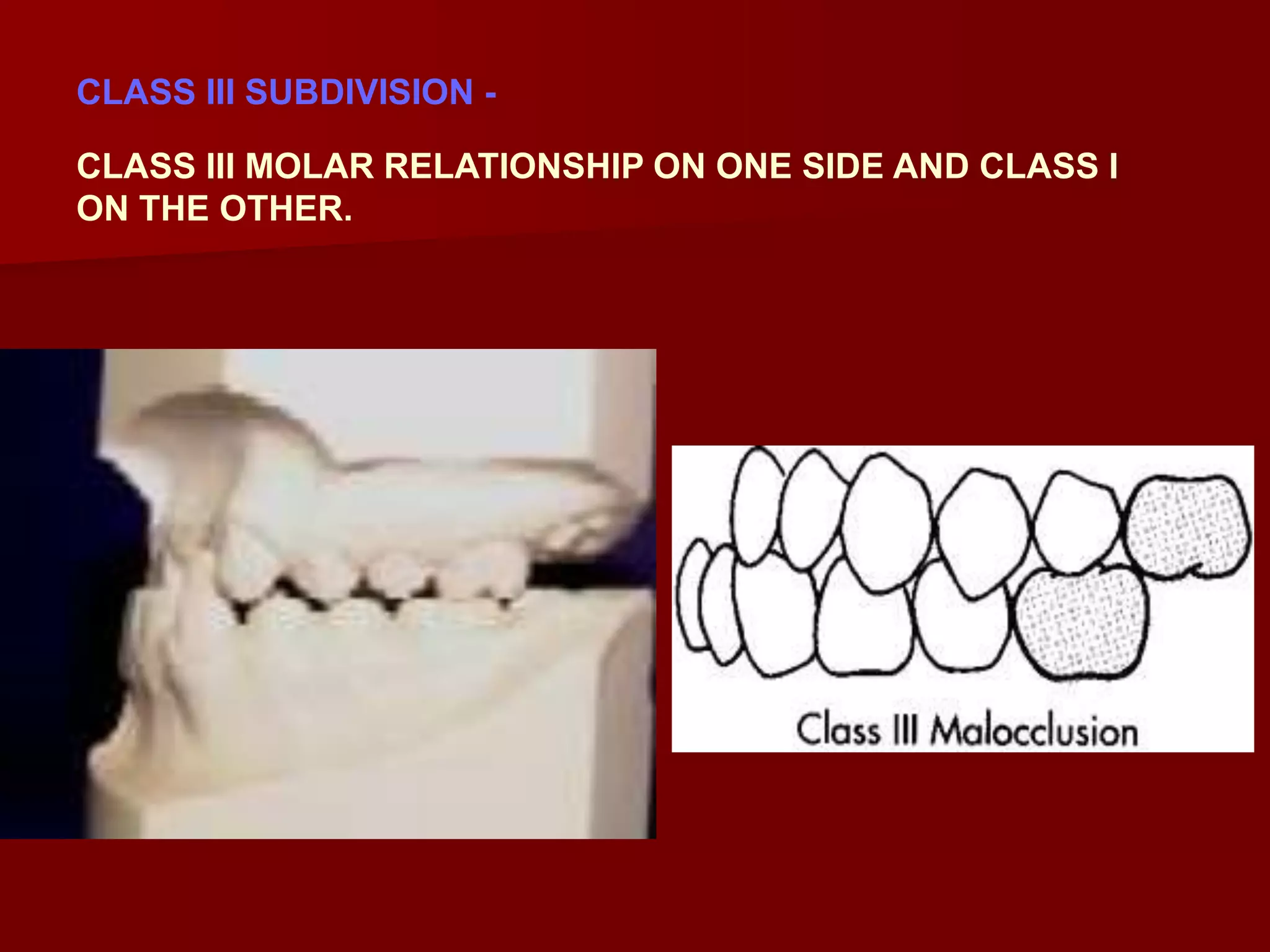 Classification of malocclusion | PPT