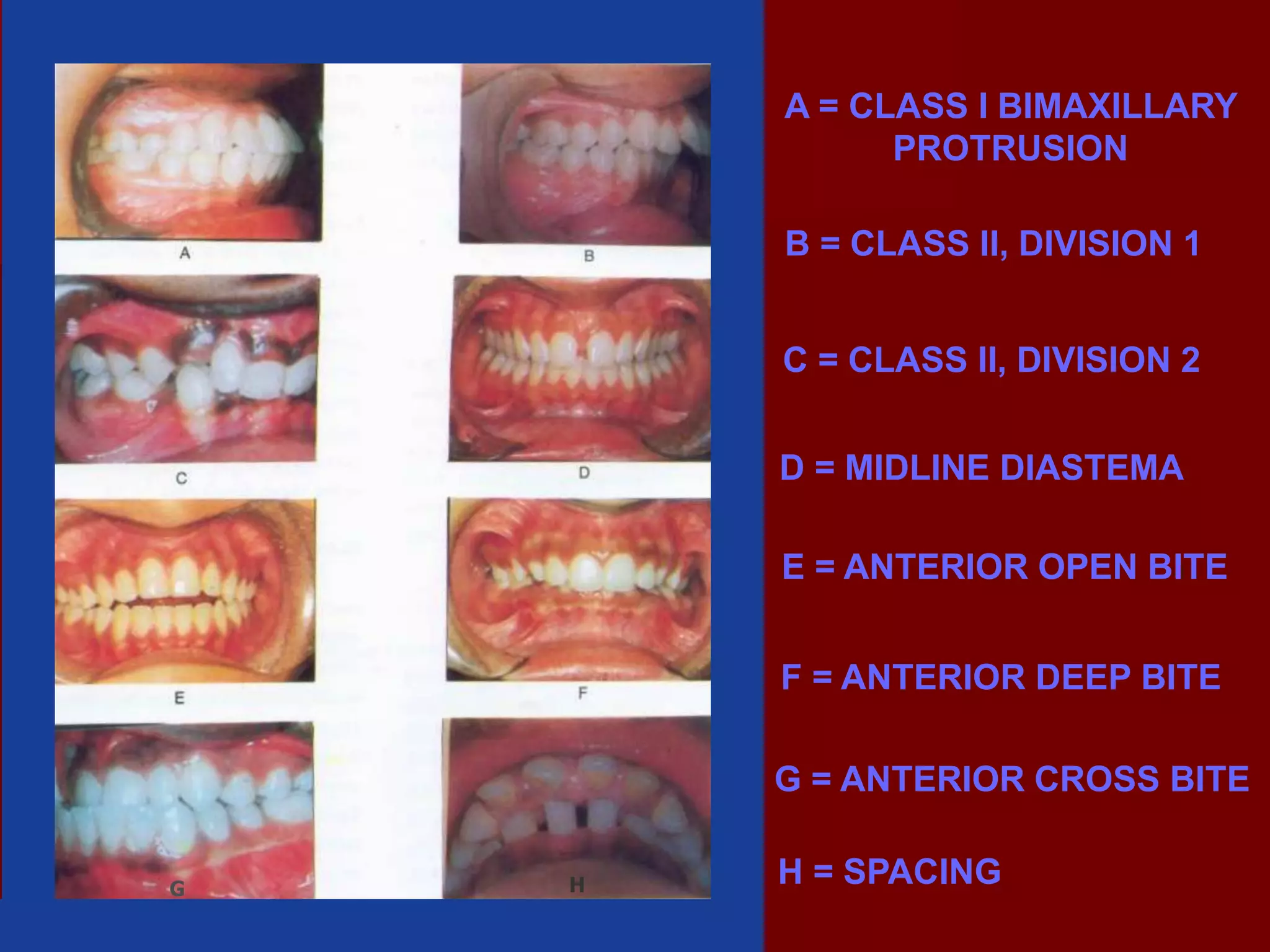 Classification of malocclusion | PPT