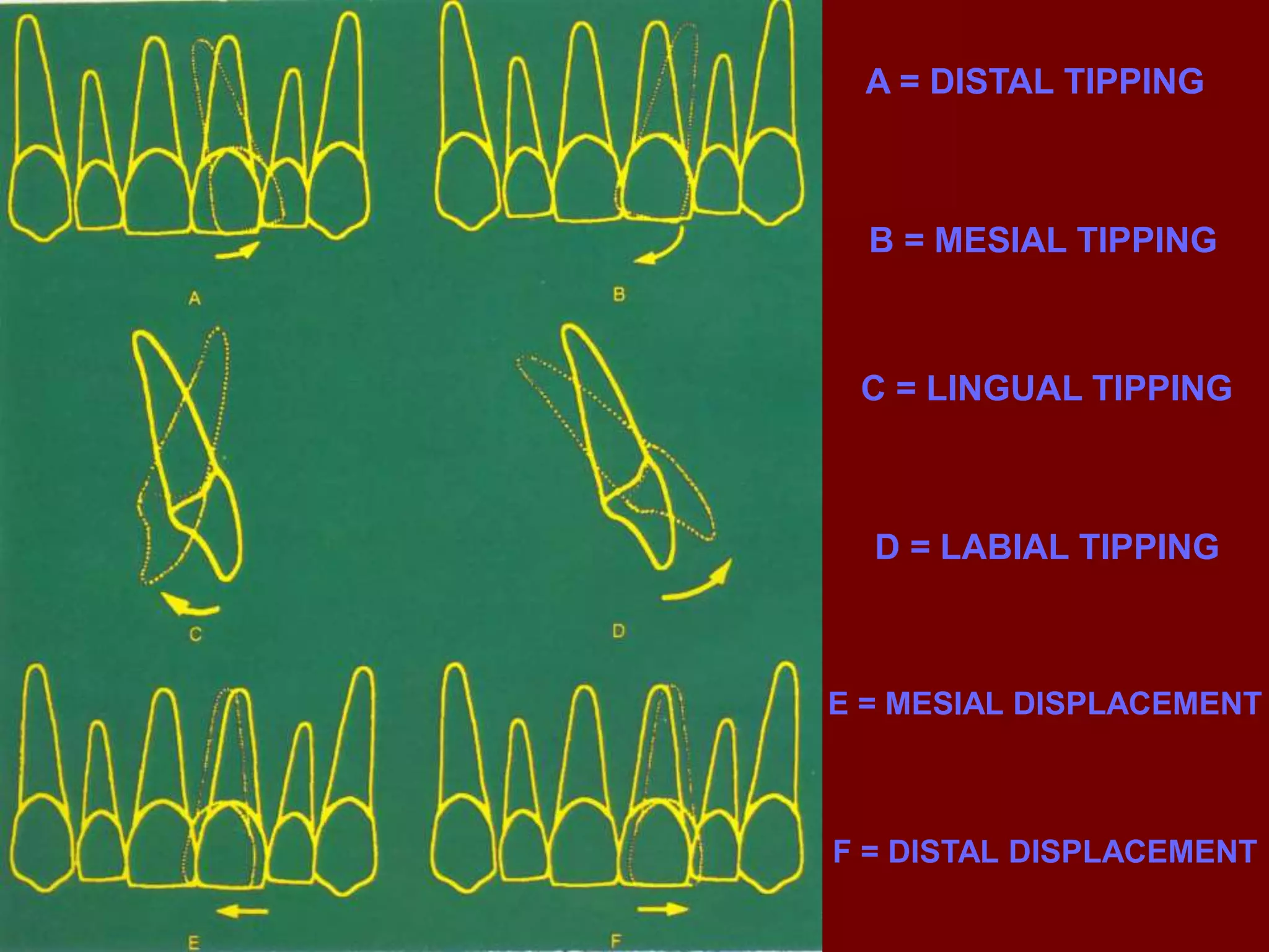Classification of malocclusion | PPT