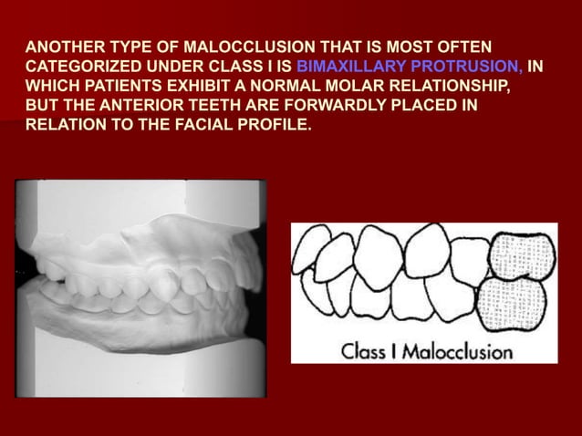 Classification of malocclusion | PPT