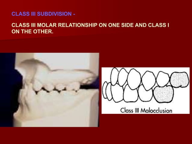 Classification of malocclusion | PPT