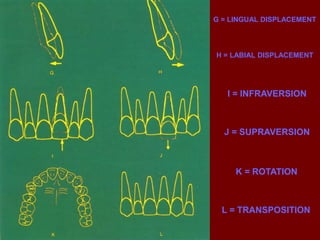 Classification of malocclusion | PPT