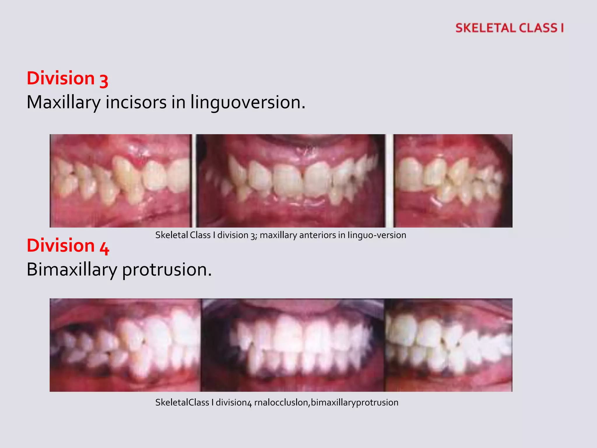 Classification of malocclusion | PPT
