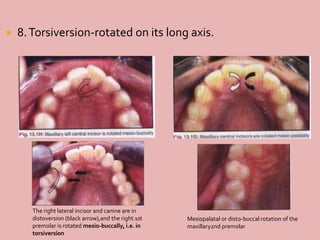 Classification of malocclusion | PPT