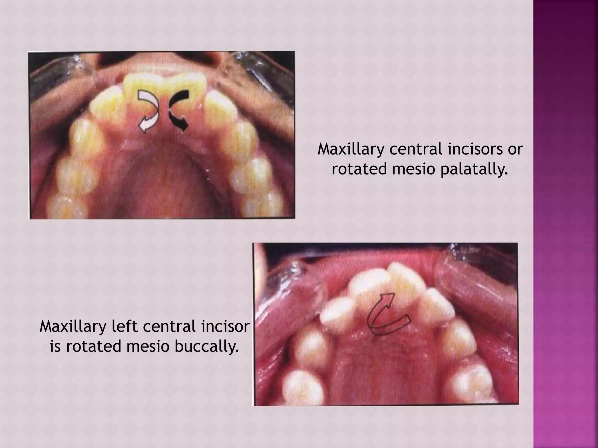 Classification ofmalocclusion | PPTX