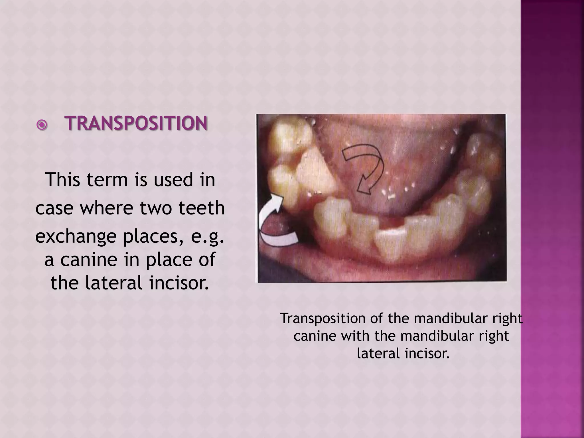 Classification ofmalocclusion | PPTX