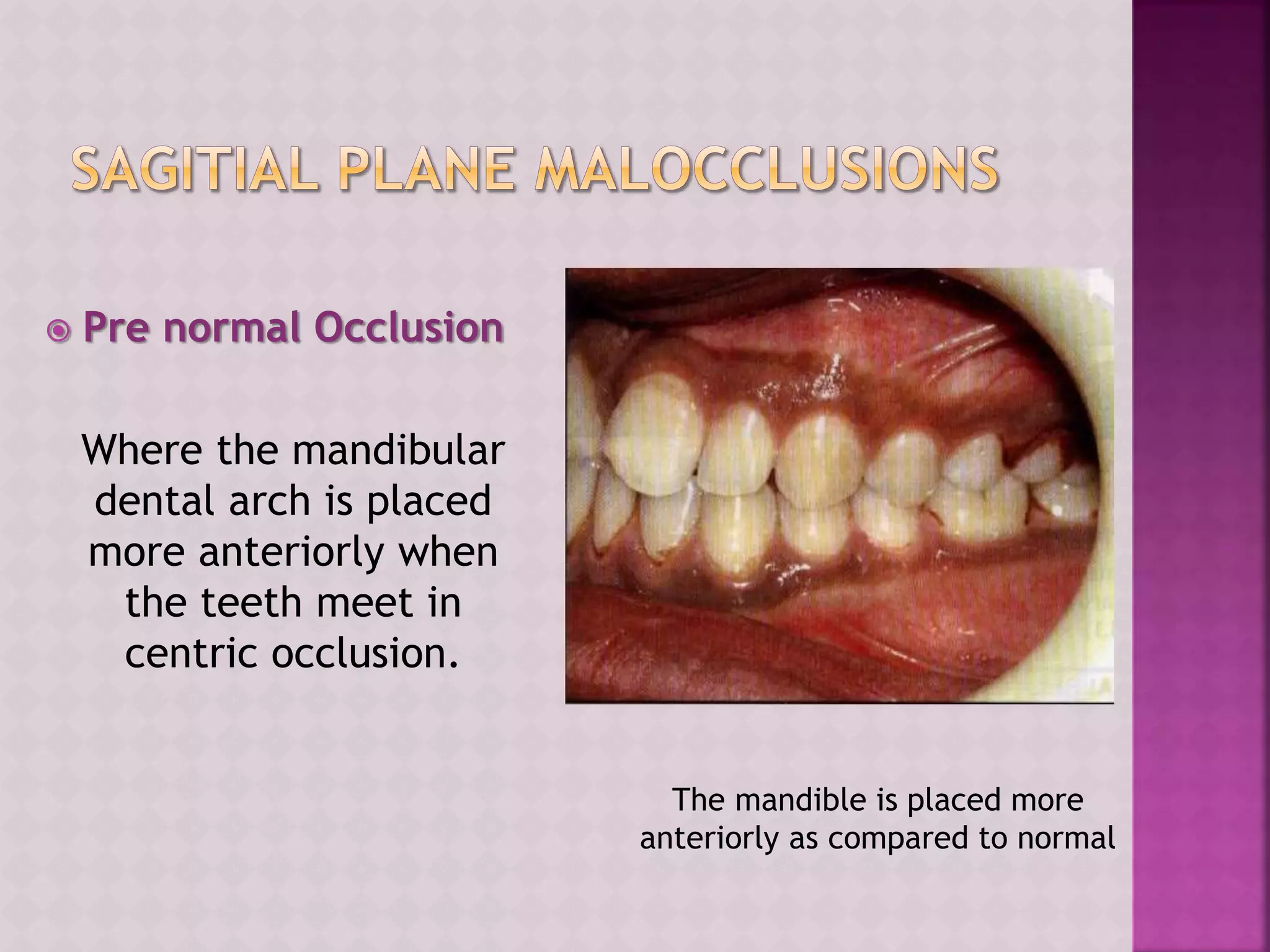 Classification ofmalocclusion | PPTX