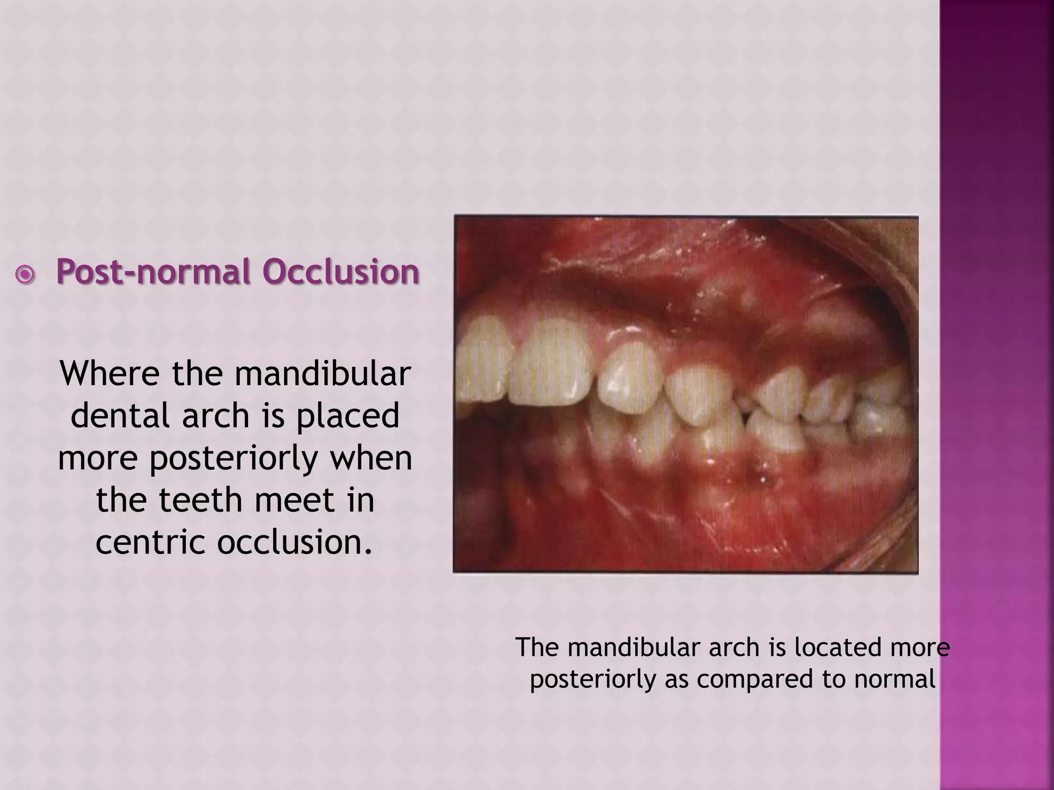 Classification ofmalocclusion | PPTX