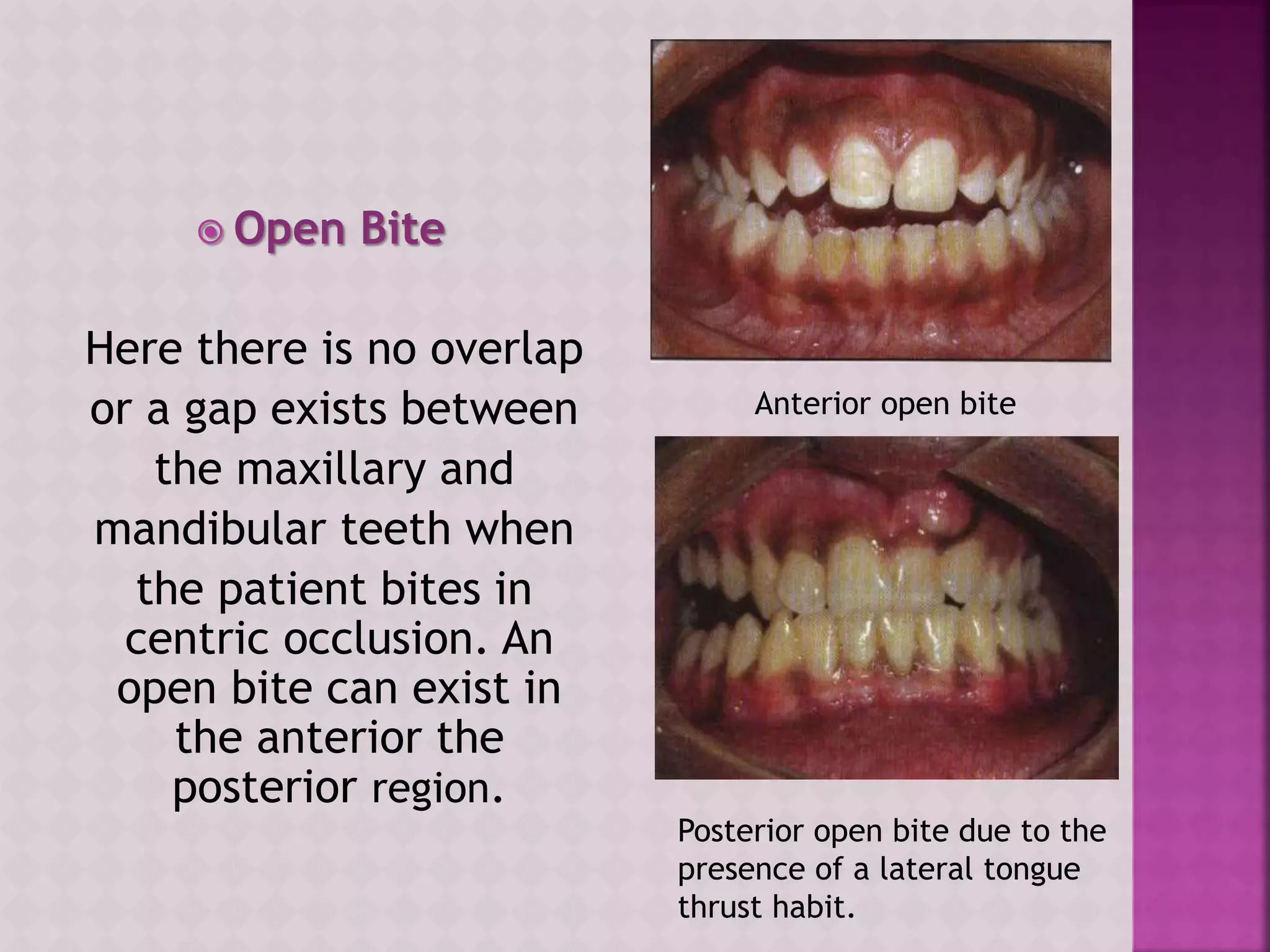 Classification ofmalocclusion | PPTX
