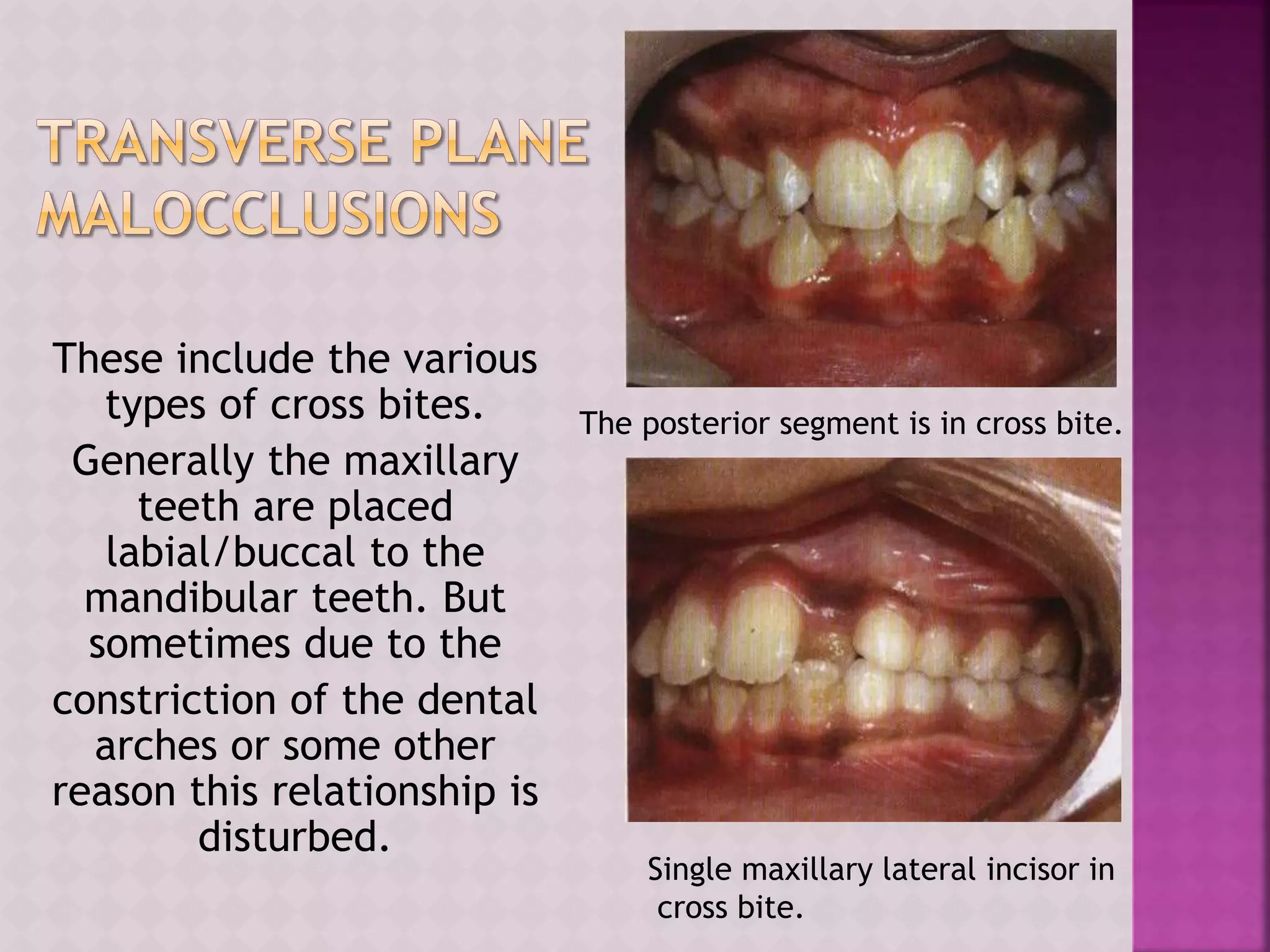 Classification ofmalocclusion | PPTX